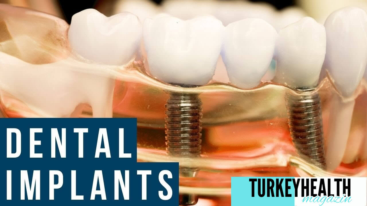 Dental Implants Istanbul | Highly Rated Clinics & Doctors