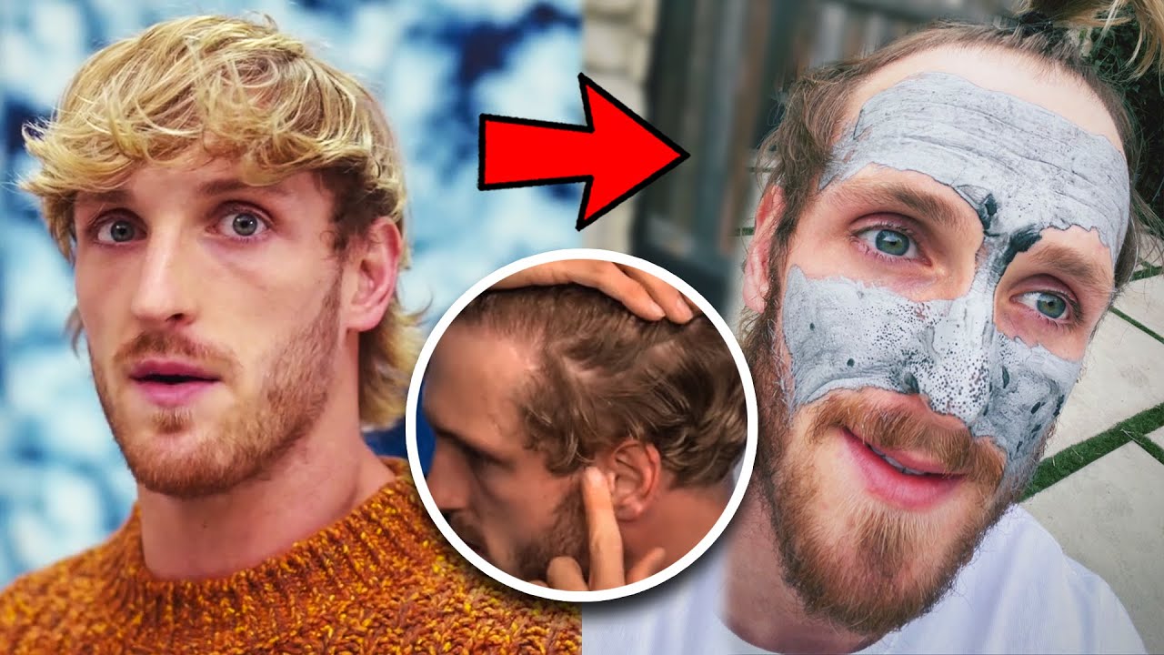 Logan Paul Hair Transplant - Before & After